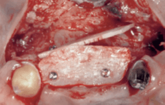 Online Dental CE Webinars And Events | Article - Management of Curved ...